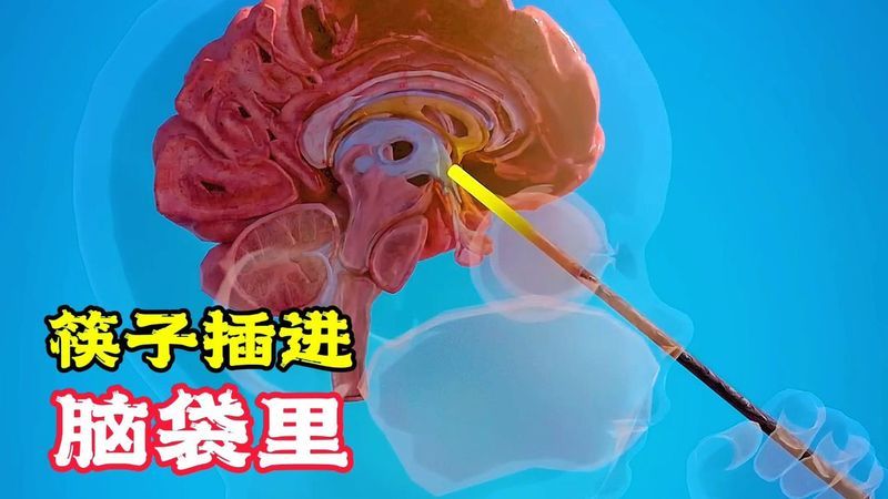 淘气的熊孩子,把筷子插进大脑,真是太危险了!科普动画
