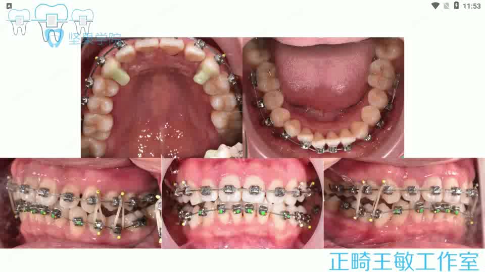 不拔牙,三颗钉结合固定矫正,极大改善前牙内倾——王敏正畸(共24节)