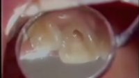 根管治疗经典教程
