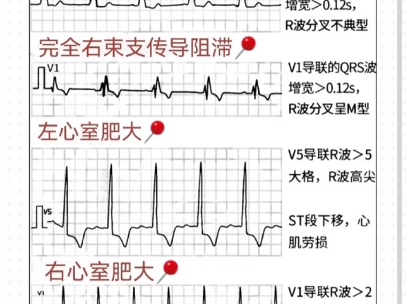 如何判断心电图,收藏学习