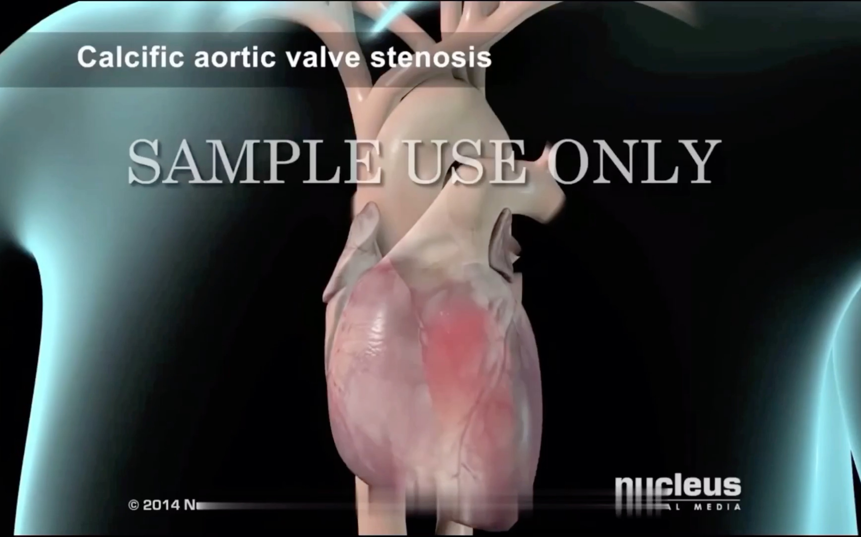 【医学动画nucleus】心脏瓣膜置换术nucleus动画演示