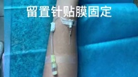 留置针贴膜固定