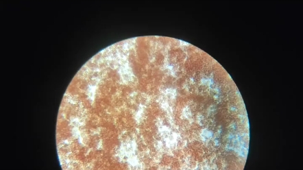 人血涂片/显微镜下由盛转哀的红细胞