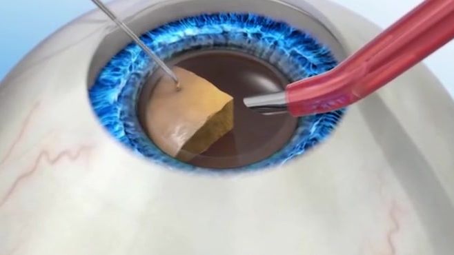 先进的现代医学科技,眼病患者的福音