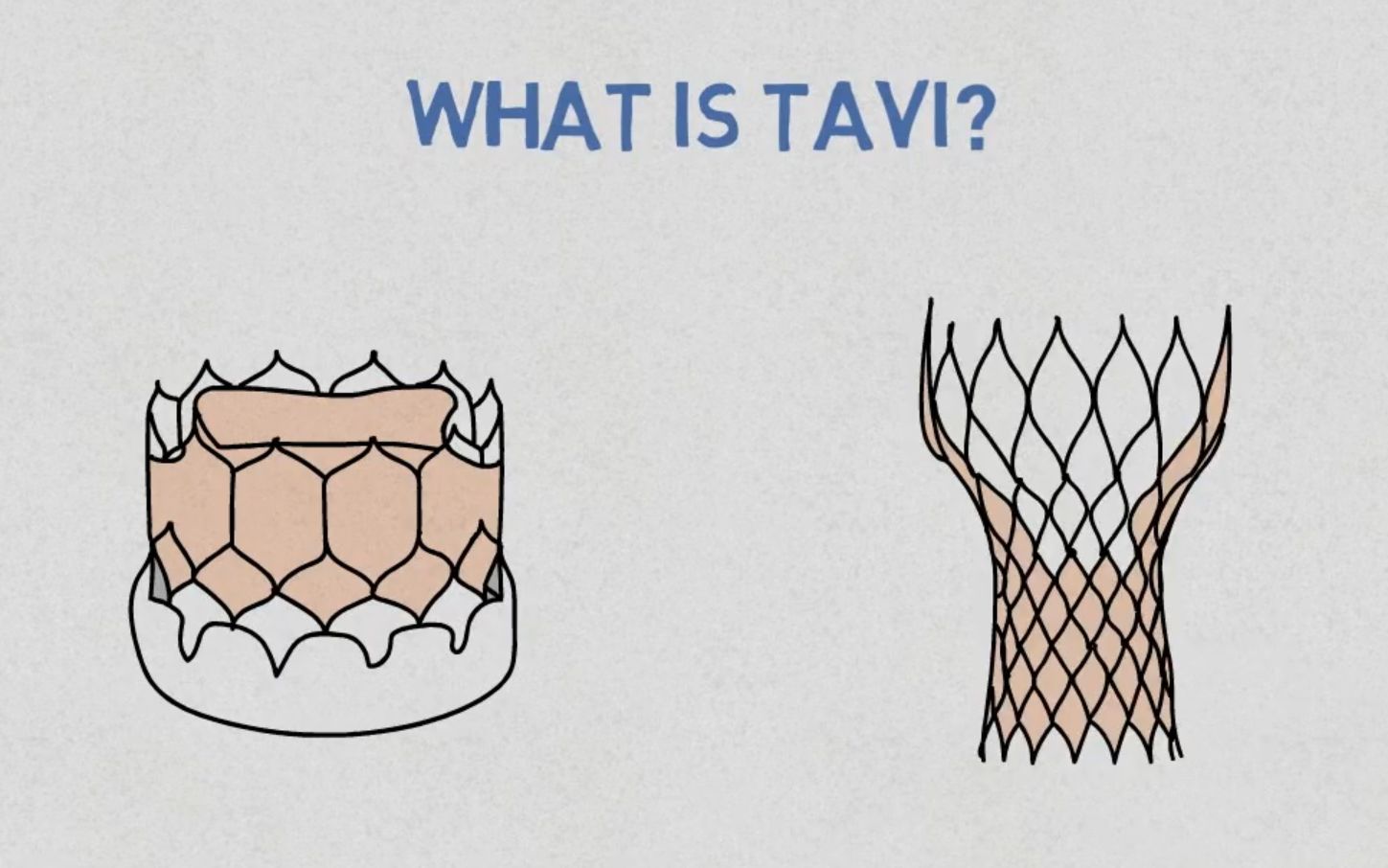 什么是TAVR(TAVI)经导管主动脉瓣介入术