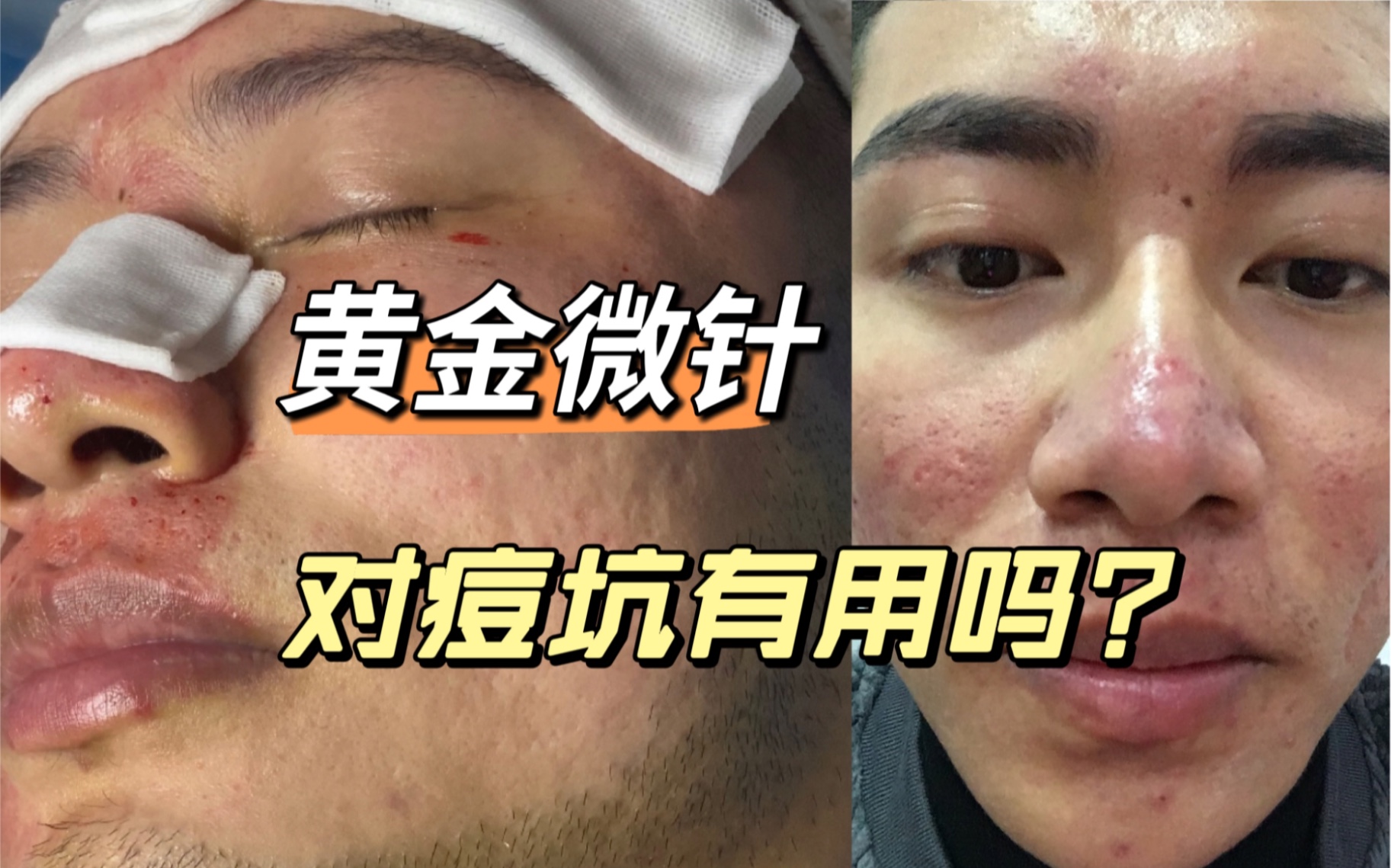 痘坑修复,做个十多次激光后,又开始黄金微针治疗