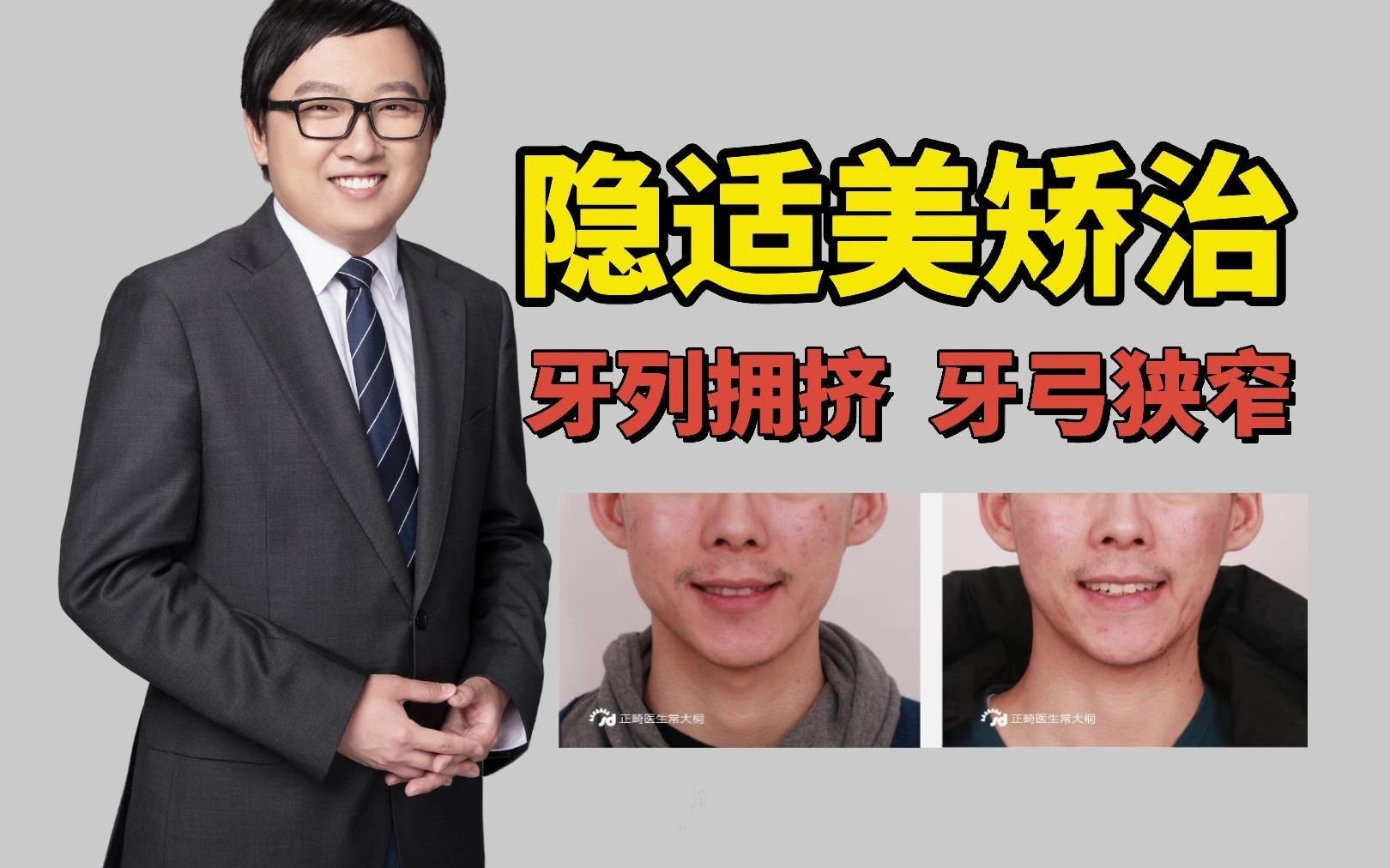 隐适美矫治牙列拥挤,牙弓狭窄