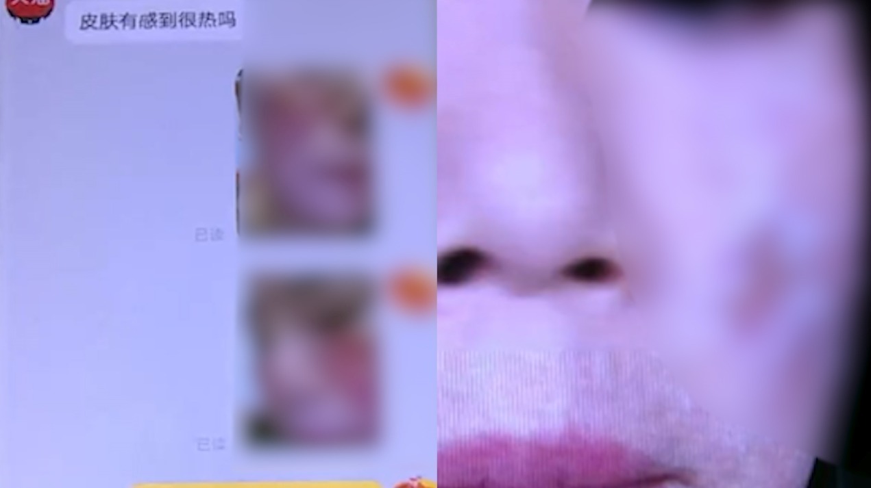 广东一女士网购美容仪,使用后脸上却成这样,照片曝光令人惊愕!