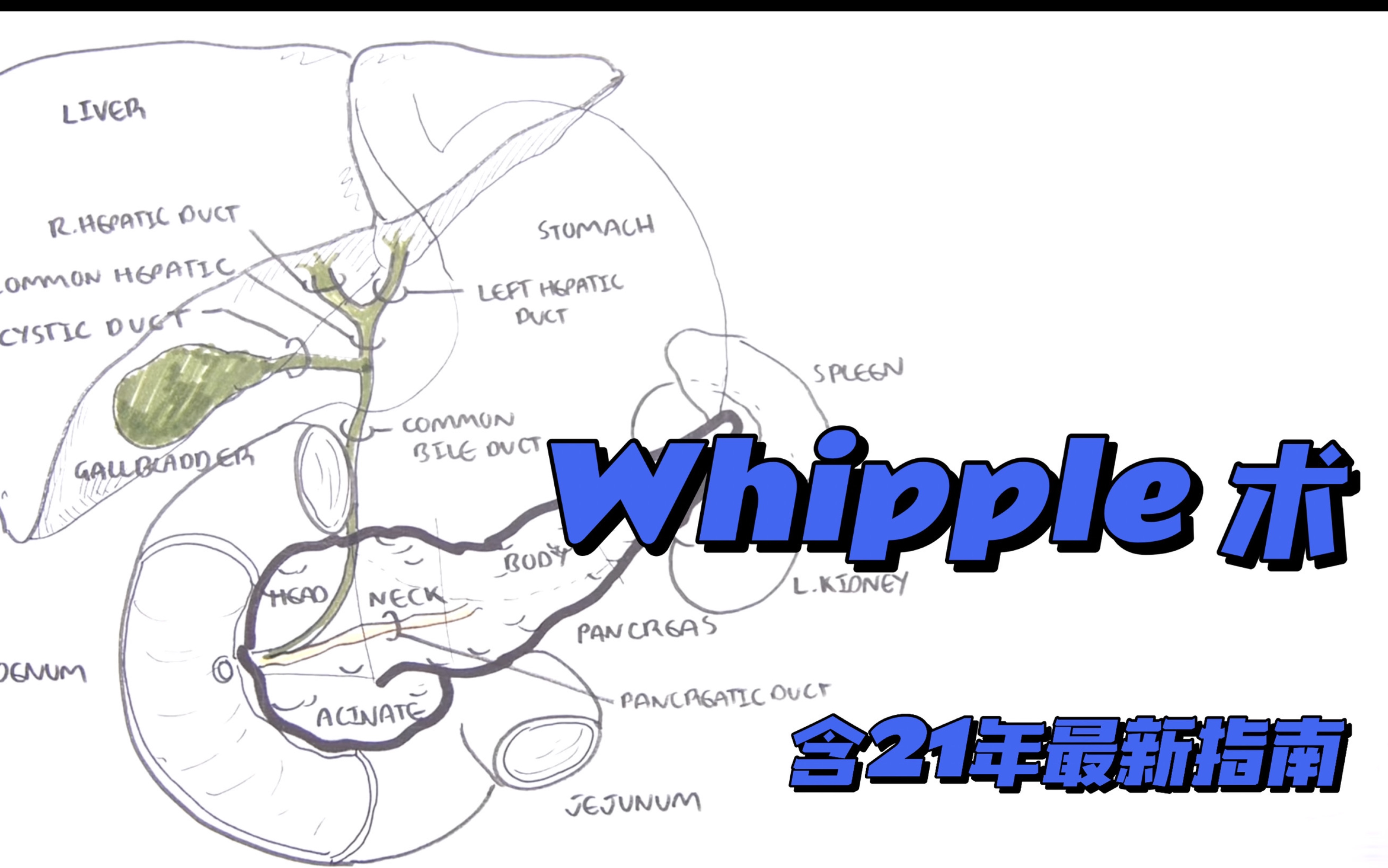 经Child法重建消化道 胰十二指肠切除术