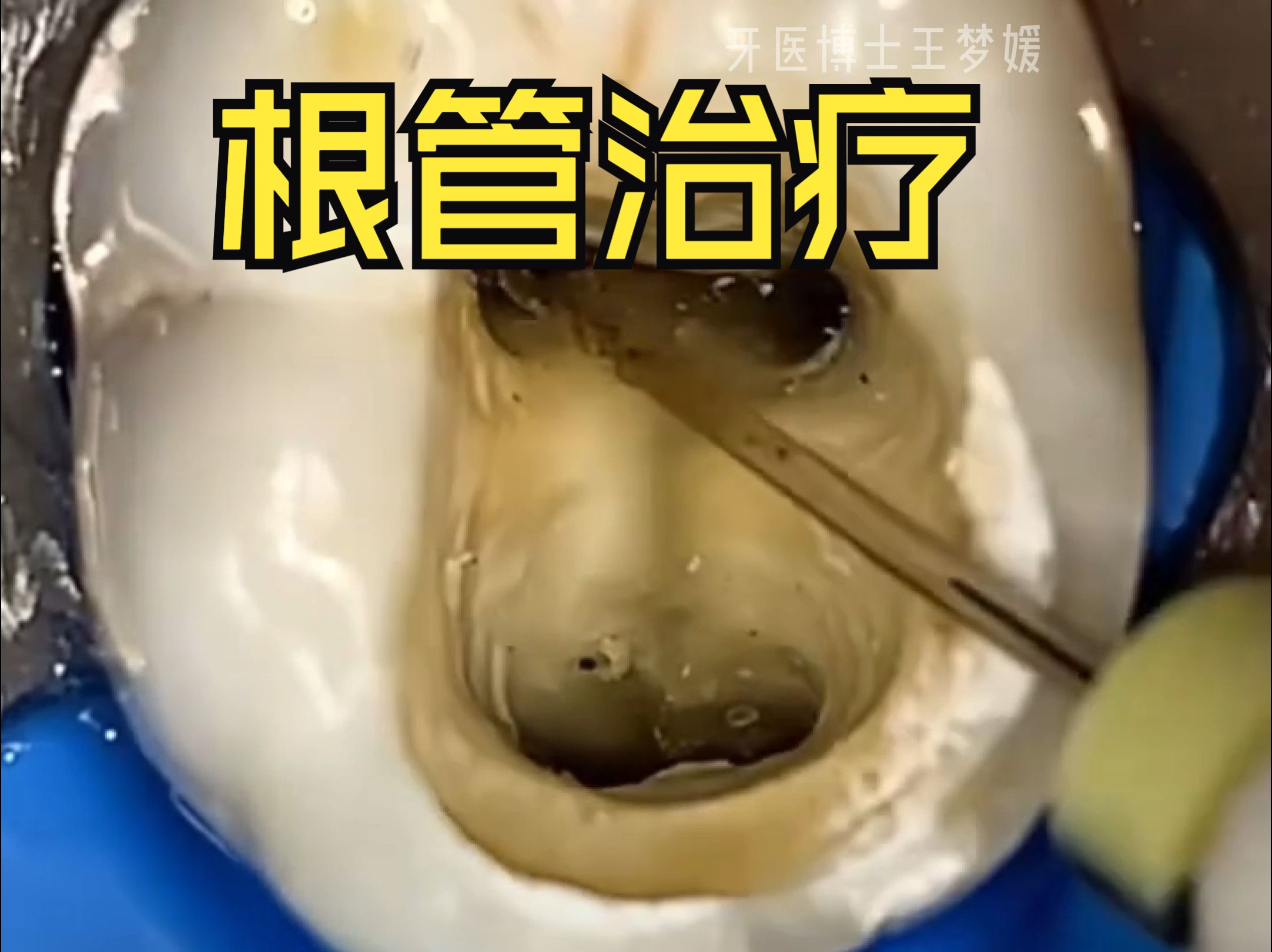 根管治疗过程来了!大家对蛀牙不能掉以轻心哦~