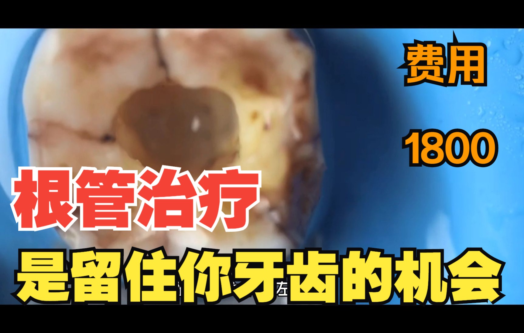 根管治疗是什么?为什么那么贵,一颗一千多