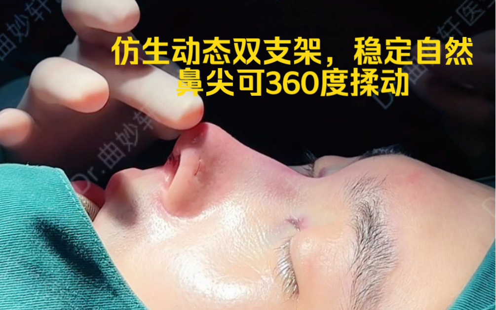 仿生动态双支架鼻尖,双支架中百分之八十是静态稳固支架、20%是...