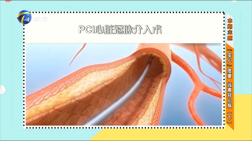 医生详解、3D动画演示:PCI心脏冠脉介入术
