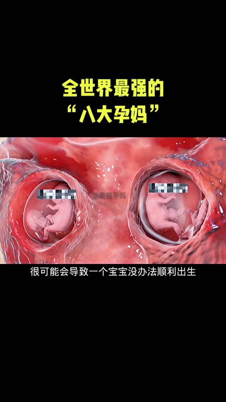 全世界最强孕妈,少见的双重怀孕