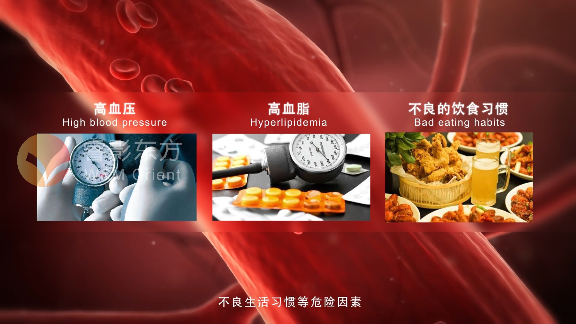 【3D医学动画】动脉粥样硬化动画