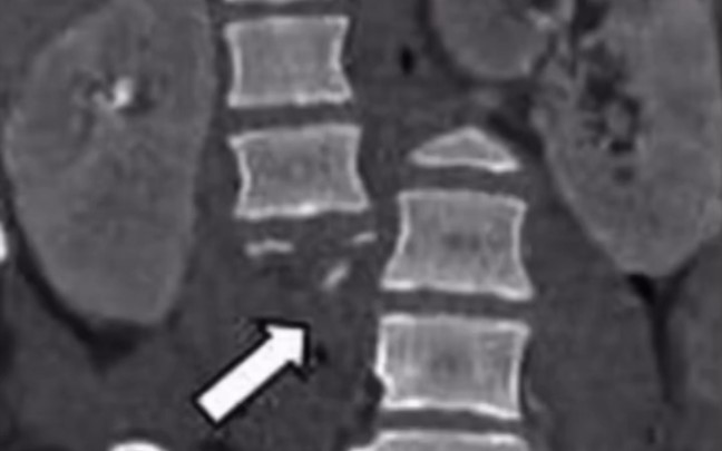 腰椎完全性骨折脱位