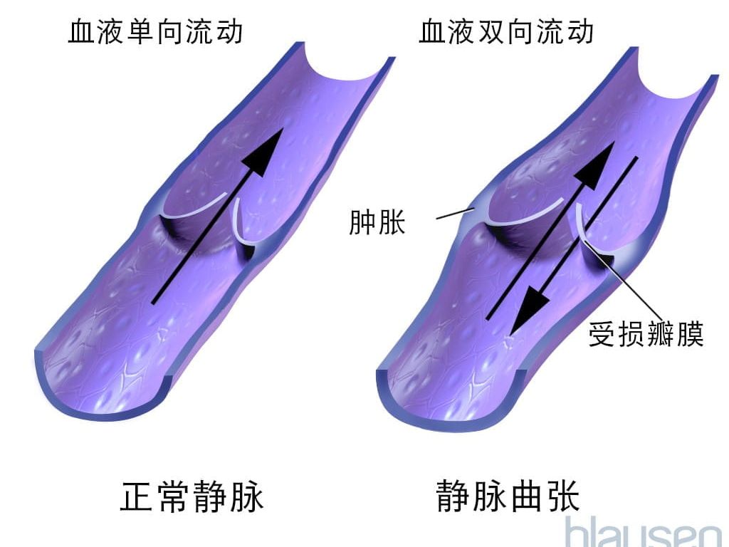 静脉曲张 - 心脏和血管疾病 - 默沙东诊疗手册大众版2022