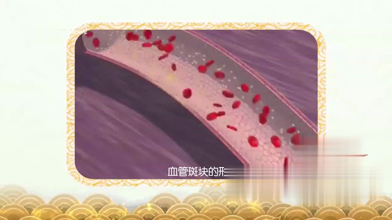 颈动脉斑块怎样消除?中医对症下药消除斑块,无副作用非常受用