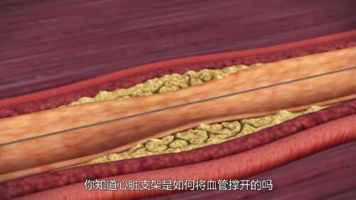 心脏支架是如何工作的?植入内部将血管撑开,3D动画演示全过程