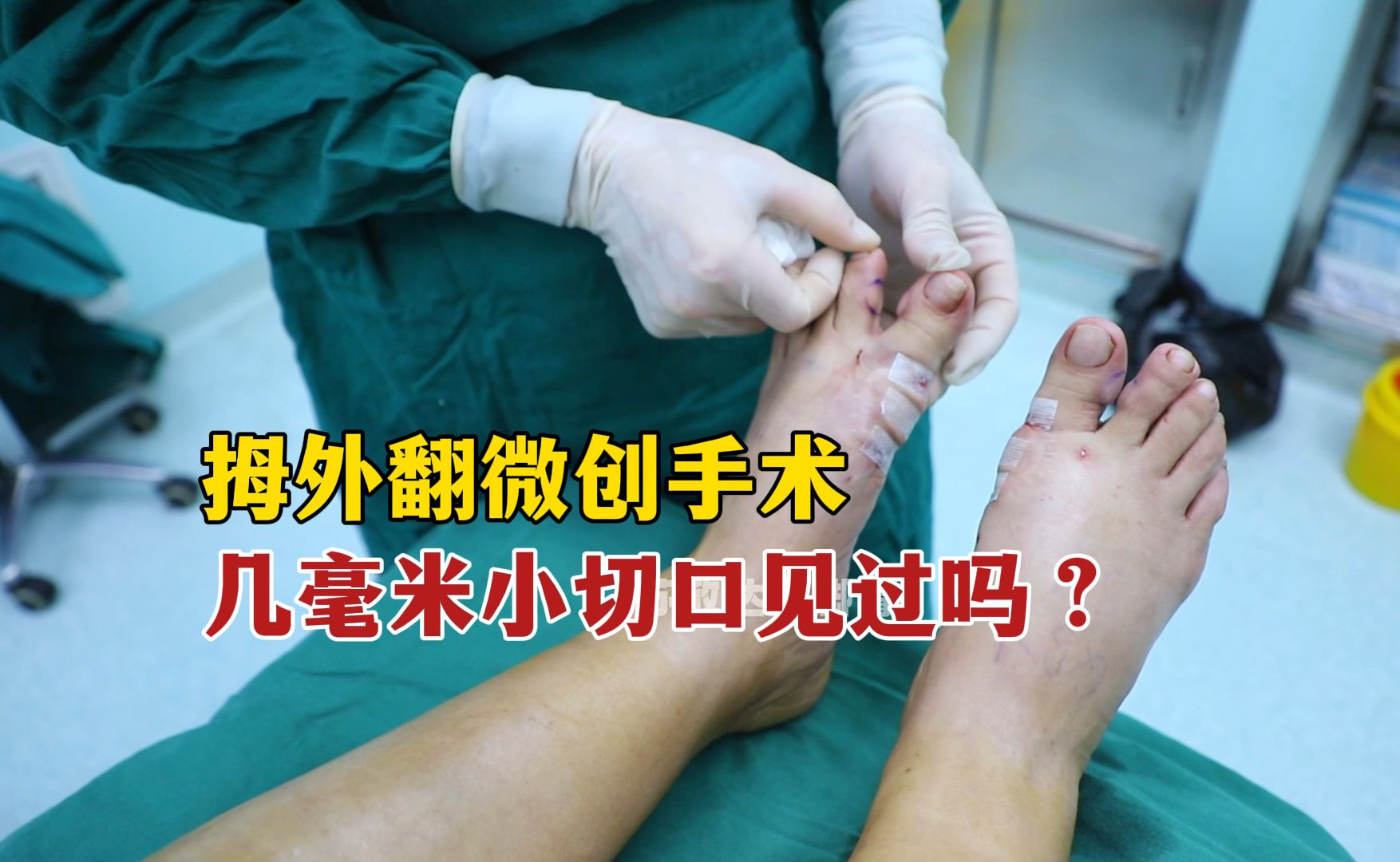 【大脚骨苏敬达】拇外翻微创手术切口仅3-5个毫米,术后阿姨很高兴...