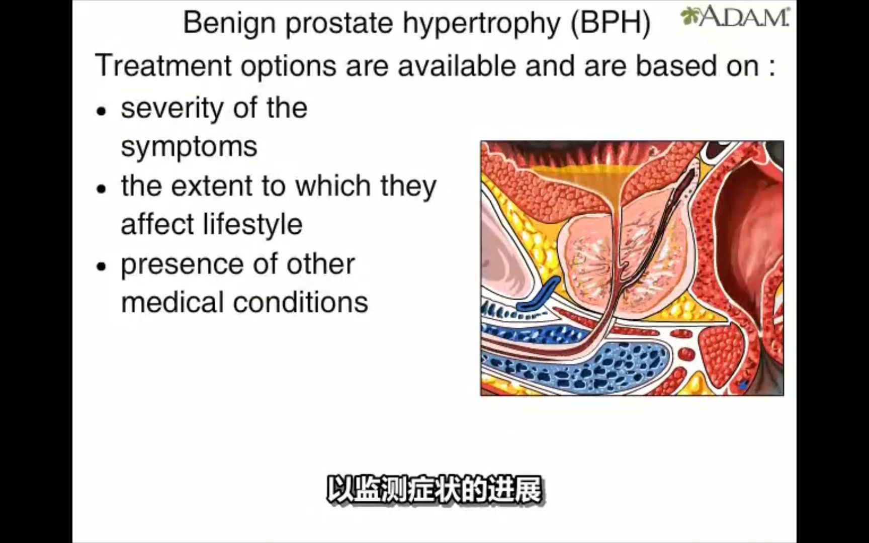 前列腺肥大良性前列腺增生动画- BPH的症状和治疗科普视频