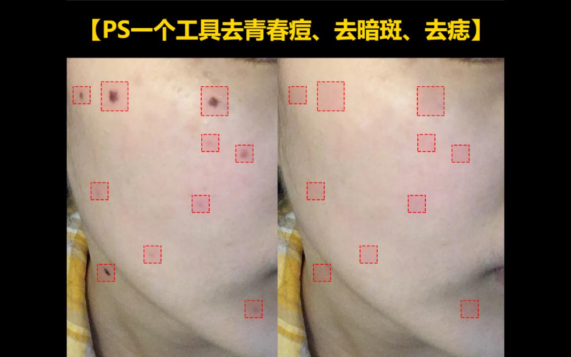 PS只用一个工具去除脸上的青春痘、暗斑、痘印,上手简单,一看就会,...