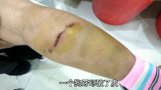 女儿被狗咬住一月要打5针,疫苗费859块钱!心疼女儿受罪了!