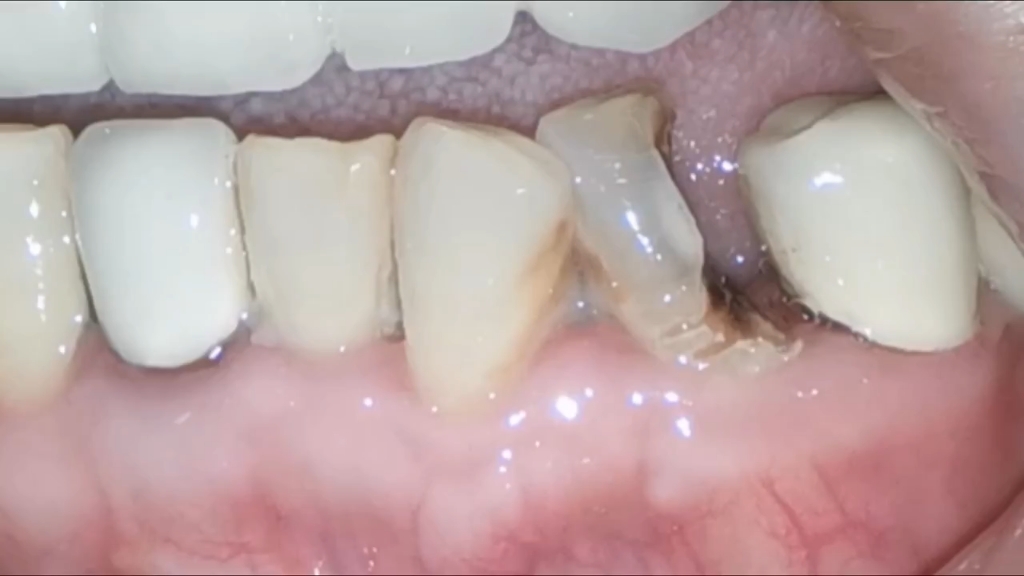 坏了一半的牙齿,清理干净后树脂制作假壁,先做根管治疗