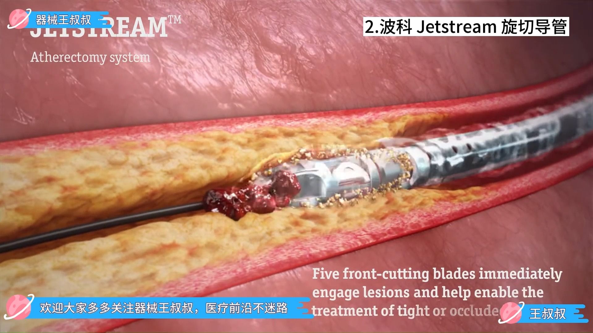 盘点那些 离谱的 血管斑块清理合集 #黑科技 #斑块旋磨 #动脉粥样化 #...