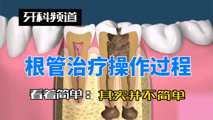 根管治疗的操作过程,看着简单,做好却不简单