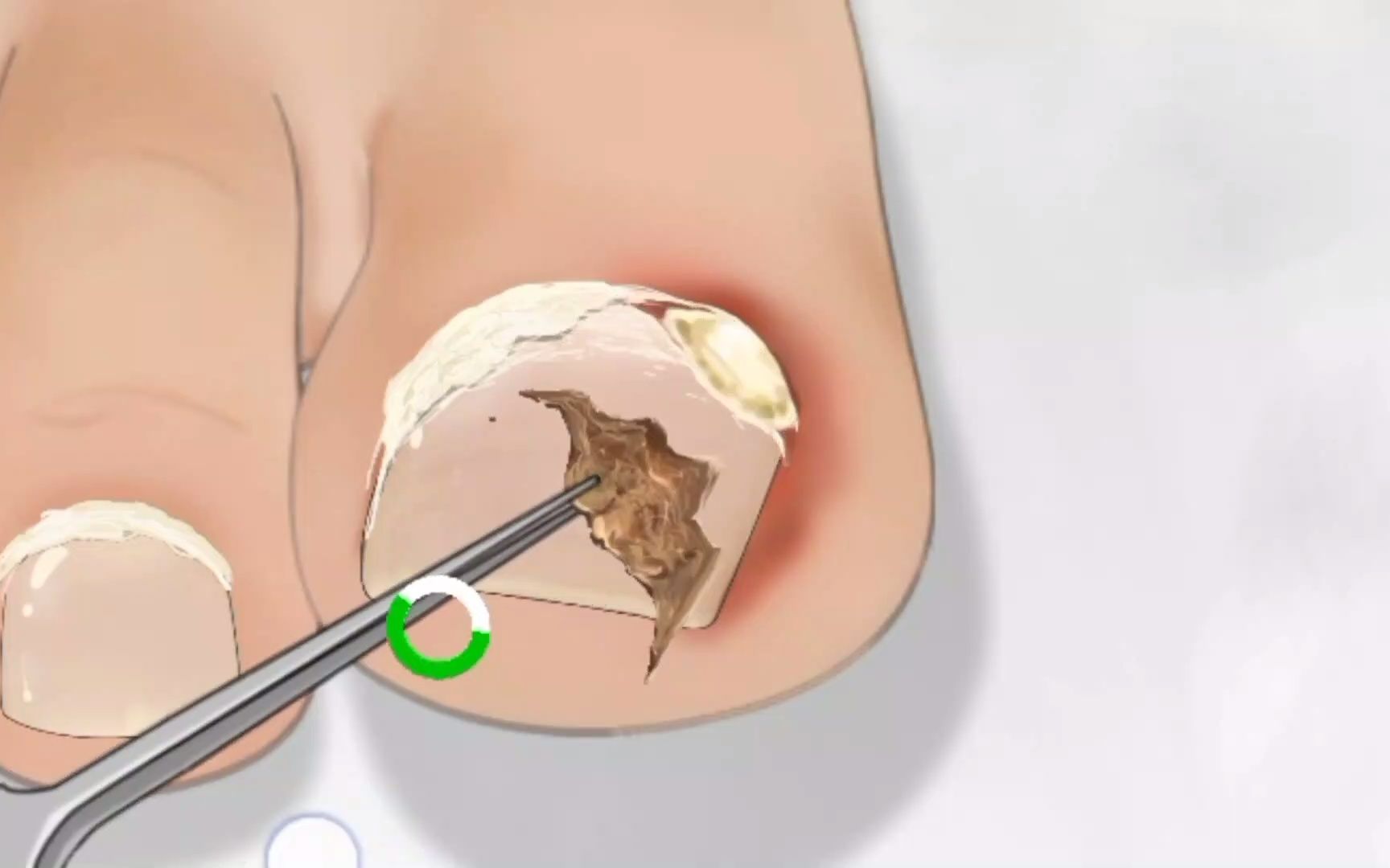 【沉浸式修脚】去除向内生长的脚趾甲动画~