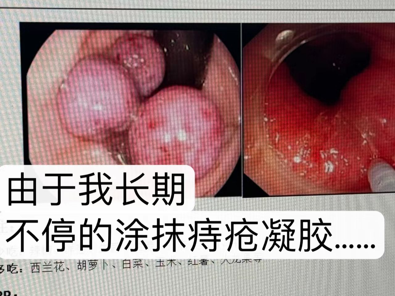 还在用土方子对付痔疮?这个方法比传统方式好10倍!