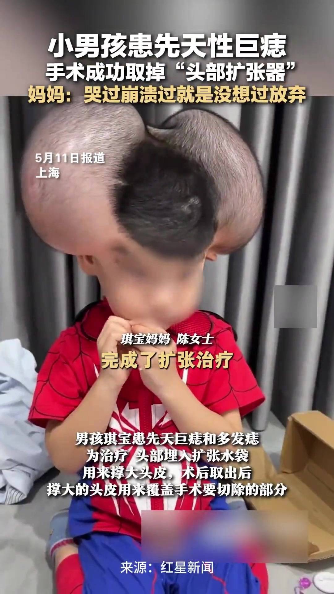 小男孩患先天性巨痣,手术成功取掉"头部扩张器"