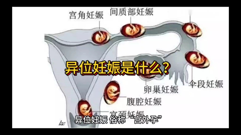 异位妊娠是什么?