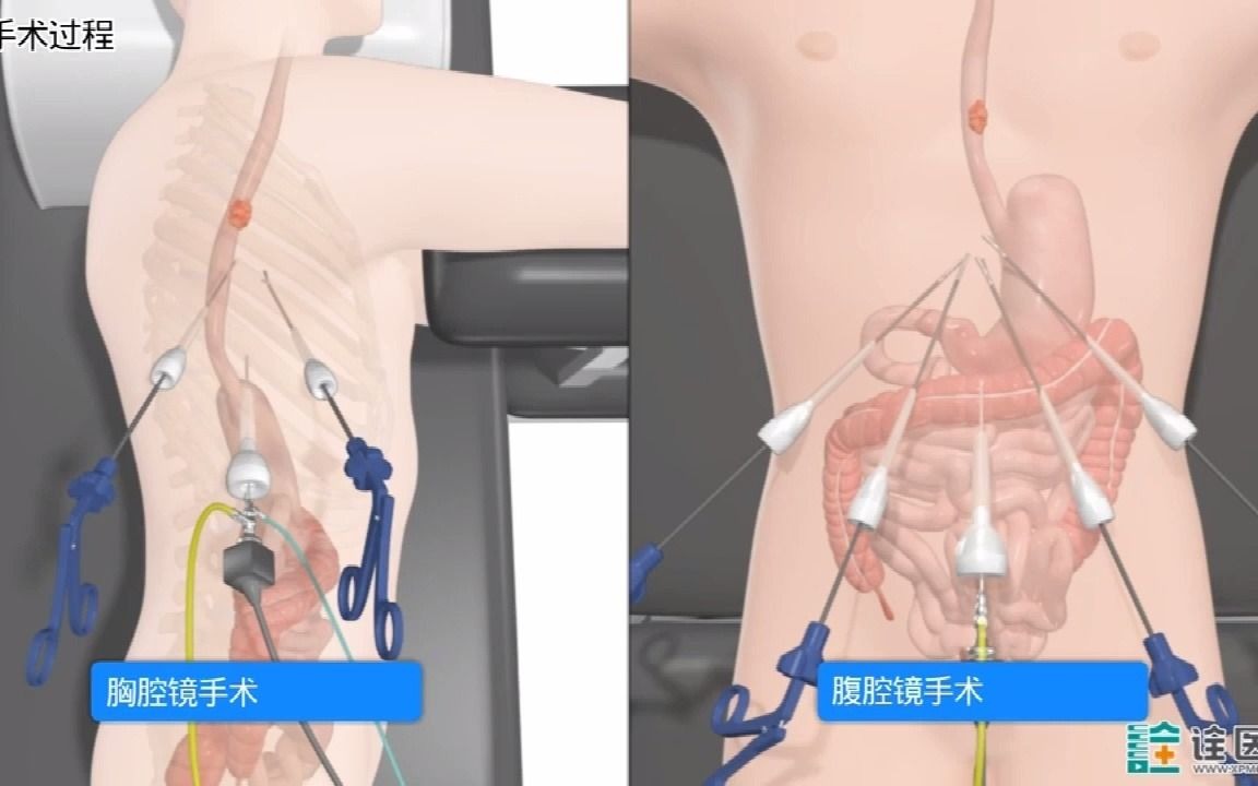 食管癌手术是怎么做的?