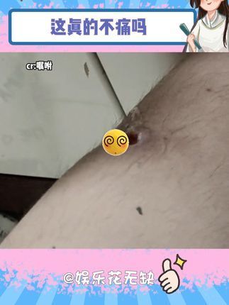 要不赔我点钱吧 #双氧水 #伤口