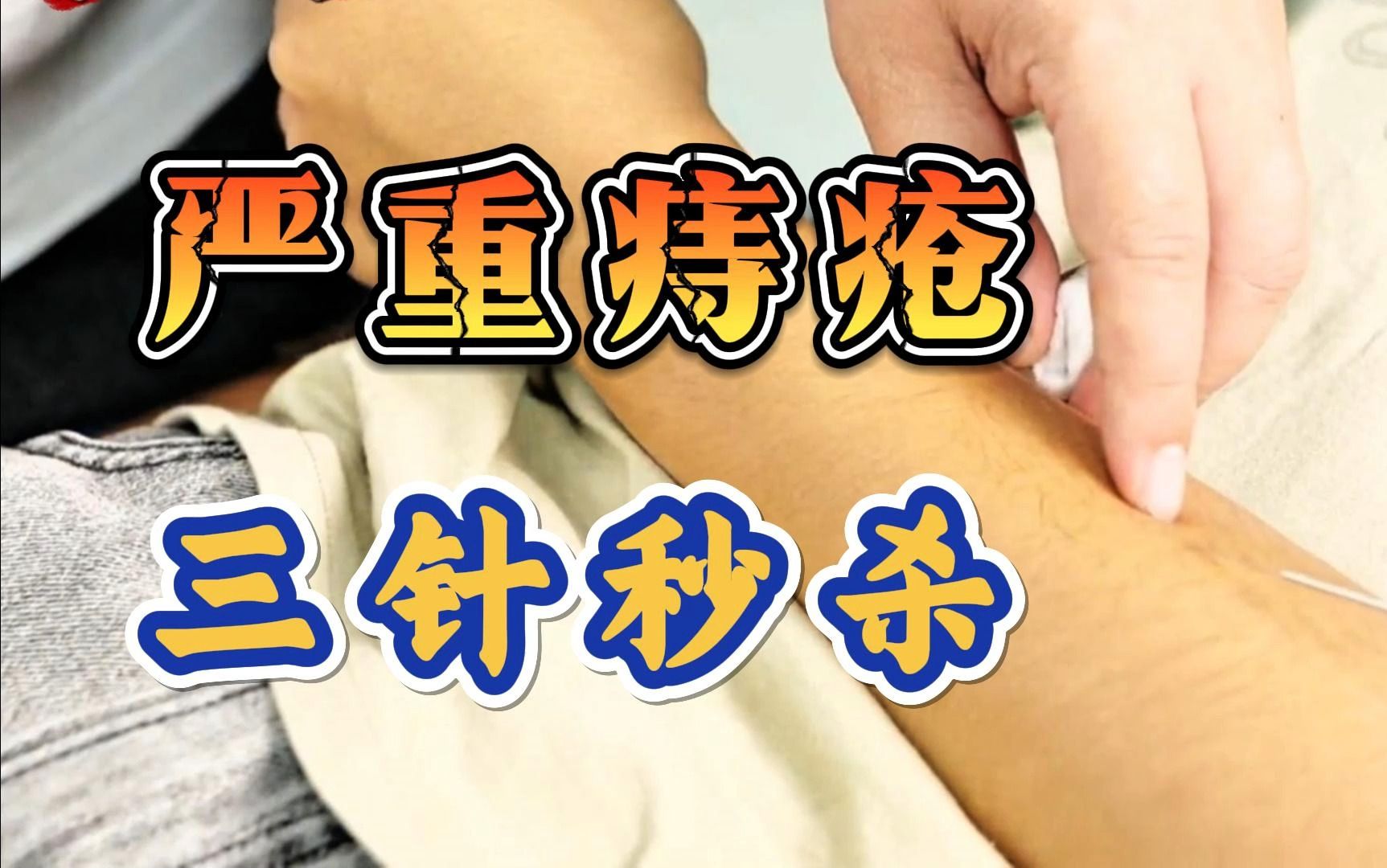 刘红云董氏奇穴:三针治愈~内痔外痔混合痔【严重痔疮】当天见效