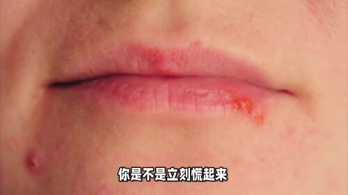 7天唇疱疹愈合全记录!关键期护理不当恐留永久疤痕