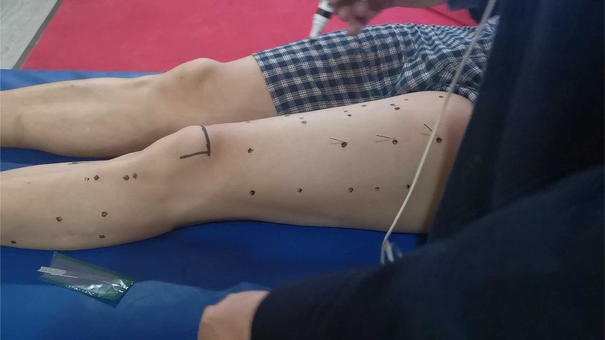 林君董氏奇穴:梁邱穴、足解穴、穴位定位