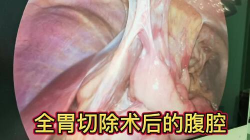 周末又遇见胃癌根治术后的腹腔镜胆总管探查取石术