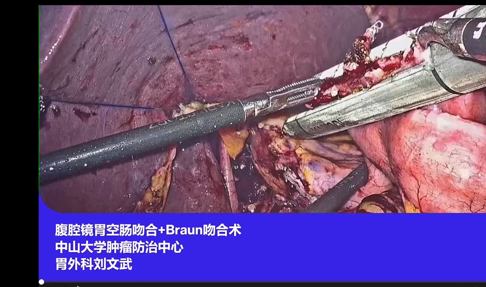 腹腔镜胃空肠吻合+Bruan吻合(讲解)