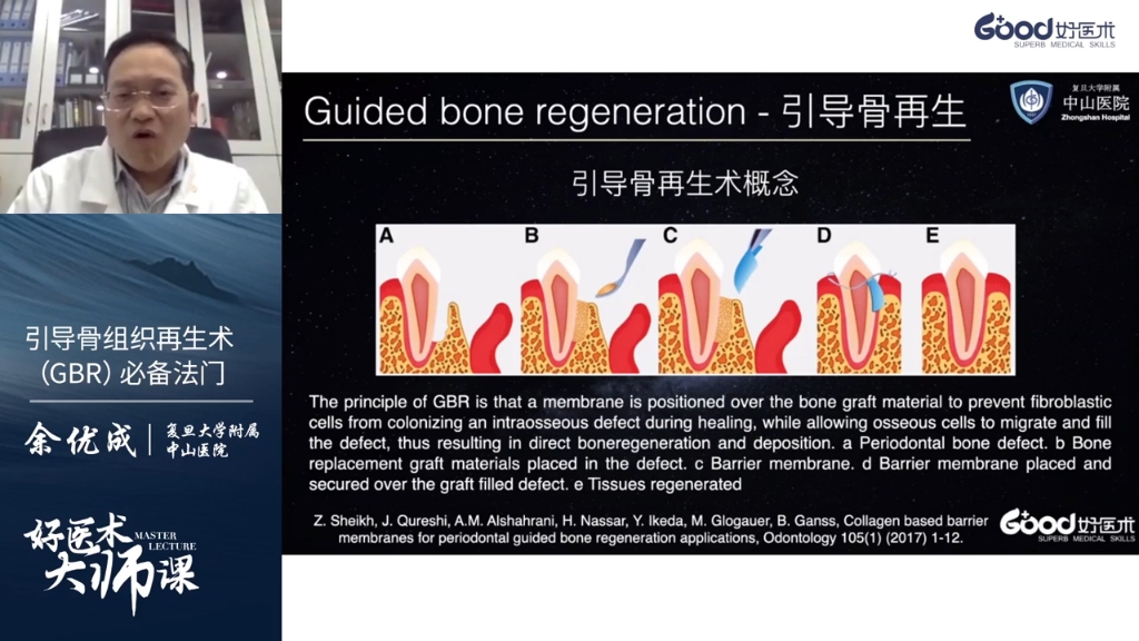 植骨增量—余优成/第三课:引导骨组织再生术(必备法门)