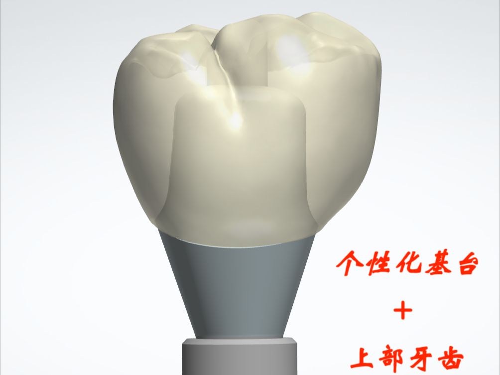 3shape软件 个性化基台+上部冠同时设计 仅供参考