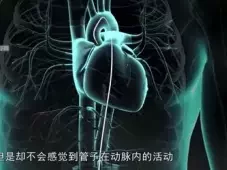 你了解心脏支架手术吗?