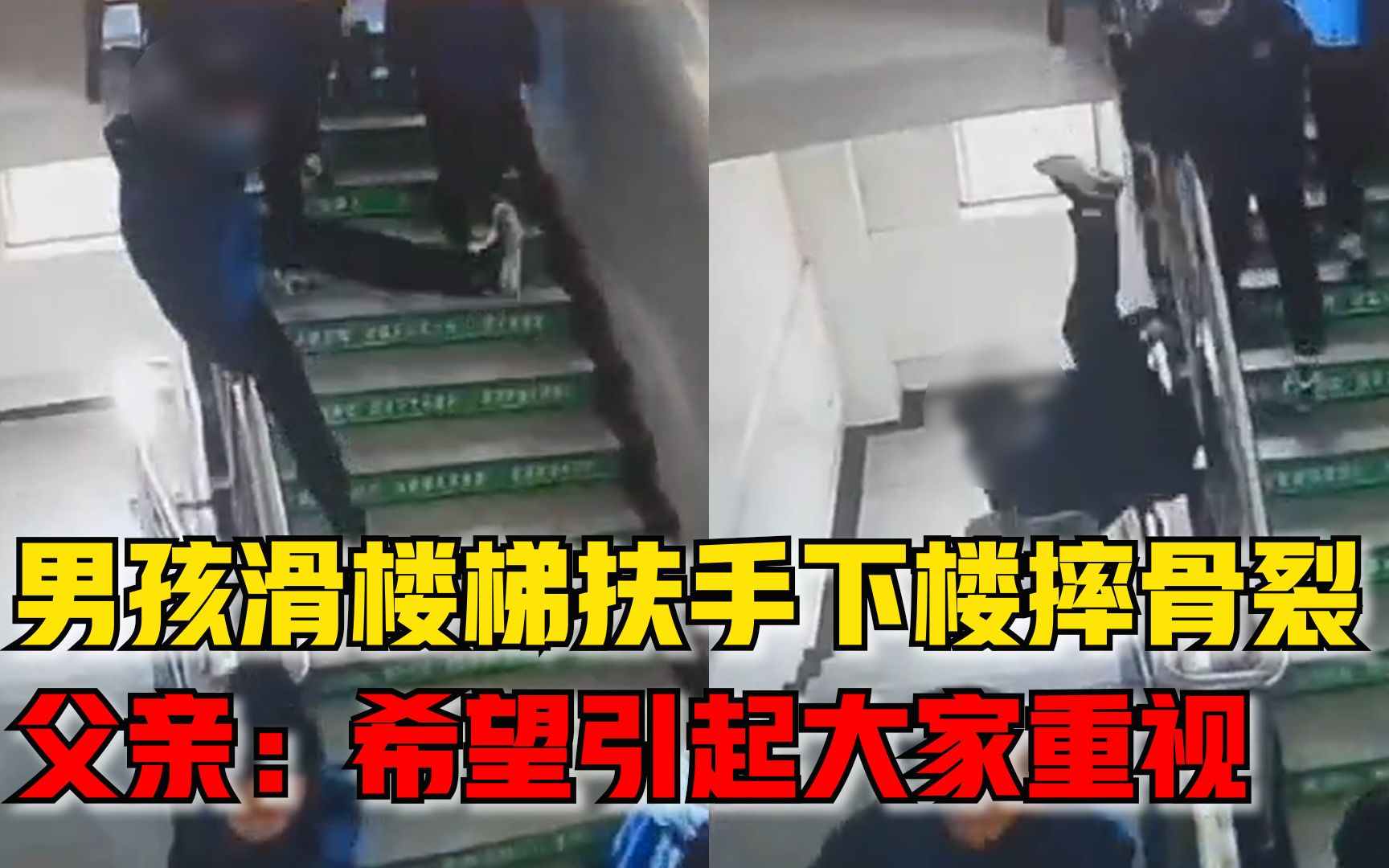 男孩滑楼梯扶手下楼摔骨裂,父亲:希望引起重视,一定要注意安全