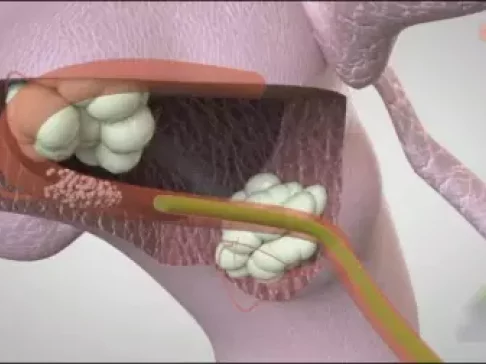 3D动画演示子宫动脉栓塞