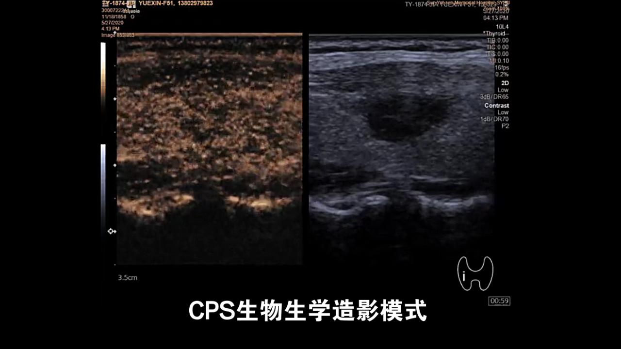CPS生物生学造影模式(右)