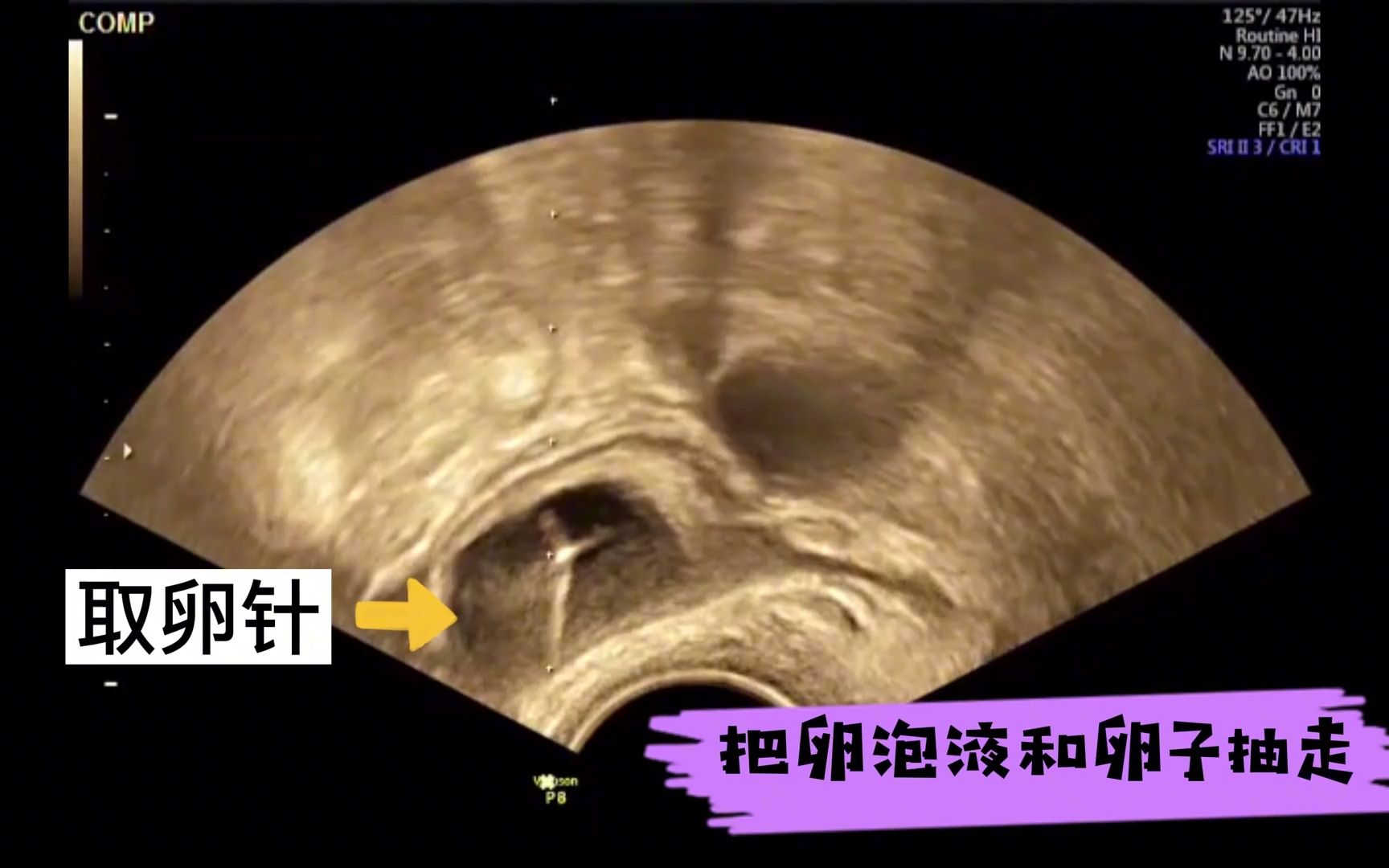 B超下试管取卵全过程,哧溜一下,暗区就不见了