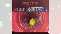 为你揭秘大便形成过程?3D动画模拟全过程重庆肛肠治疗最好医院?
