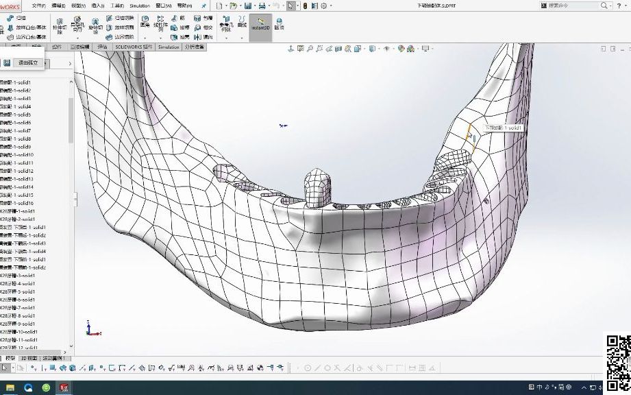口腔生物力学-正畸(3)SolidWorks牙齿跟牙槽骨的固定配合、术后模型...